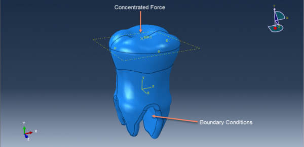 Bio-Mechanical Abaqus Simulation Full Package - CAE Assistant Bio-Mechanical Abaqus Simulation Full Package - CAE Assistant