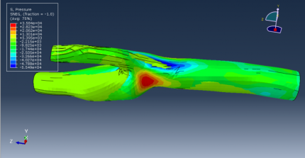 Bio-Mechanical Abaqus Simulation Full Package - CAE Assistant