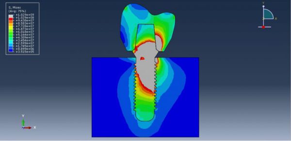 Bio-Mechanical Abaqus Simulation Full Package - CAE Assistant