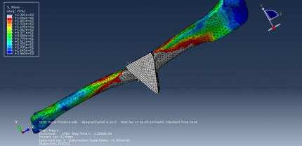 Bio-Mechanical Abaqus Simulation Full Package - CAE Assistant